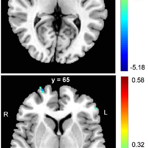 The Alterations Of Frontal Cortex In Dc Values Of Pd Patients The Pd The Alterations Of Frontal Cortex In Dc Values Of Pd Patients The Pd