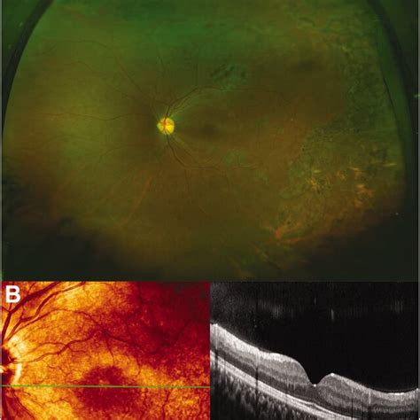 Fundus Photograph Of The Left Eye Obtained 2 Months After Retinal