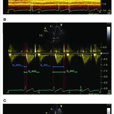 Simultaneous Sample Recordings Of Ecg Scg Icg And Pcg Signals