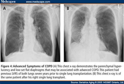 Copd Chest Xrays