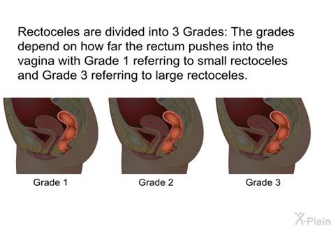 Rectocele Grading Scale