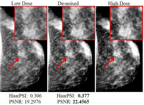 Results Of Our Gan Based De Noising Model Tested On Real Dbt Central Download Scientific
