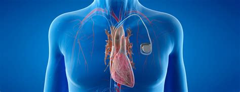 Leadless Pacemaker Treatment Dr Vivek Kumar Cardiologist