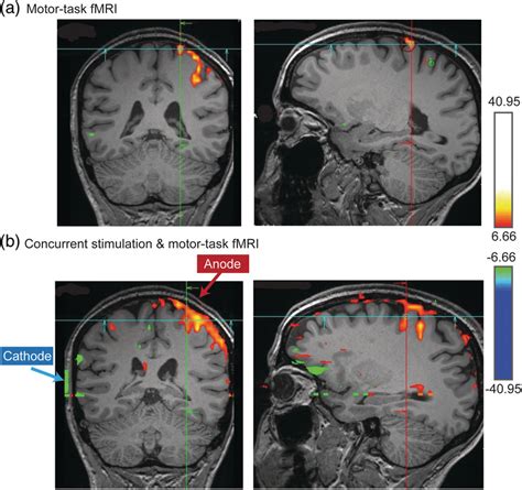 Concurrent Stimulation And Imaging Artifact Fmri Activation During Hand Download Scientific