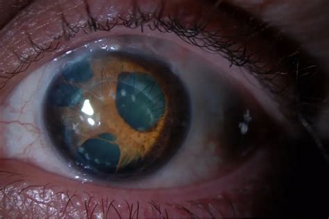 Iridocorneal Anomalies In Infants American Academy Of Ophthalmology