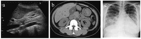 A Ultrasonography Revealed An Edematous Gallbladder B Non Contrast