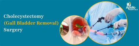 Kolecystektomi Borttagning Av Gallblåsa Typer Kostnad Procedur Och återhämtning