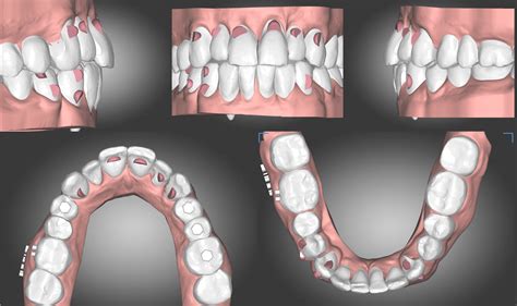 Ao Attachment Protocol For Aligners Adaptive Orthodontics