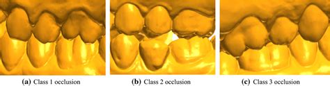 Illustration Of Different Types Of Dental Occlusion Download Scientific Diagram