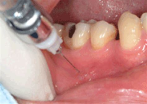 Local Infiltration Anesthesia At Kaitlyn Fitzhardinge Blog