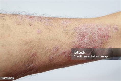 인간의 피부 염증이있는 피부 건 선의 붉은 부어 오른 피부 딱지 민감한 피부 피부 질환 치료 의료 이미지 필링 피부 건강관리와 의술에 대한 스톡 사진 및 기타 이미지