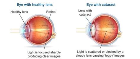 Bladeless Laser Cataract Surgery Singapore Dr Natasha Lim
