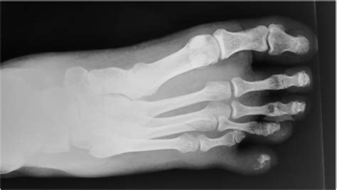 Initial Anteroposterior Radiograph Note The Displacement Of The 5th Download Scientific