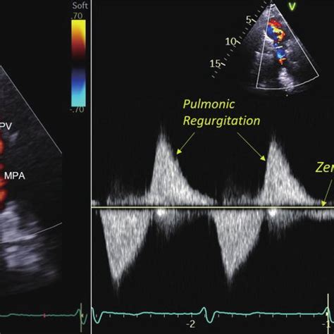 Malalignment Ventricular Septal Defect Vsd With Eisenmenger Syndrome
