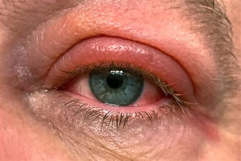 Can Swelling Cause Pink Eye
