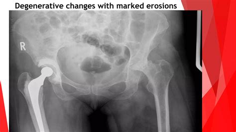 Differential Diagnosis Of Musculoskeletal Involvement In Rheumatoid Arthritis Sle And Systemic