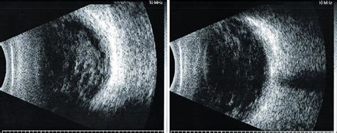 Bilateral Ocular Ultrasound Vitreous Opacification Download
