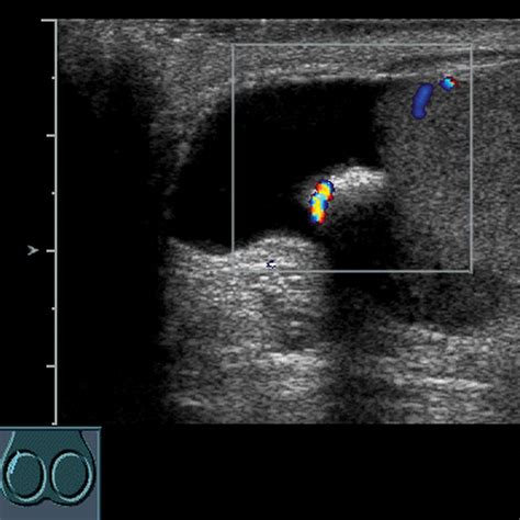 Color Comet Tail Artifact Clinical Applications Ajr