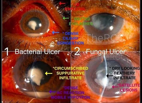Rao Musaddaq Ali On Linkedin Bacterial Keratitis Vs Fungal Keratitis