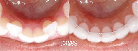 CA Clear Aligner Bangkok Affordable Clear Aligners Thailand CDC Dental
