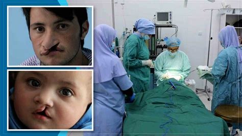 ناهنجاری‌های لب‌چاک و کام‌چاک؛ از مشکلات صحی تا تأثیرات روانی و