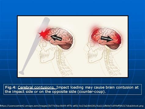 Revisited Imaging Findings And Pathophysiology Of Abusive Head