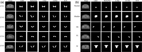 Typical Automatic Delineation Results From 2d Models A Clinical Download Scientific Diagram
