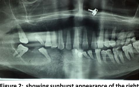 Figure 4 From Osteosarcoma Of The Mandible Developed After Tooth Extraction Treated With Surgery