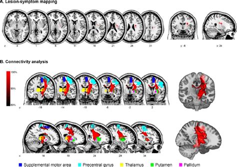 Imaging Analysis After 7 Days A Voxel Based Lesion Symptom Mapping