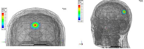 Wireless Power Transfer And Sar Simulation Of Implantable Medical Devices Using Ansys Hfss