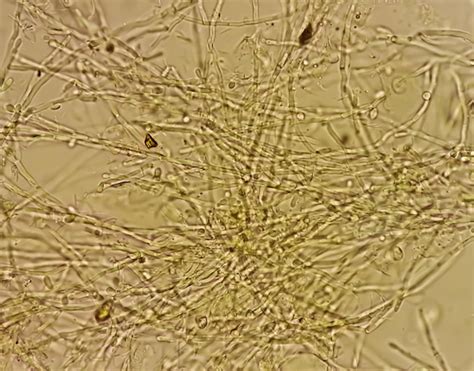 Premium Photo Pseudohyphae And Budding Yeast Cells In Patient Urine