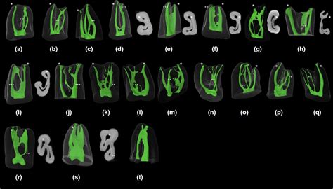 The Root Canal Anatomy Project Fused Maxillary 2nd Molars