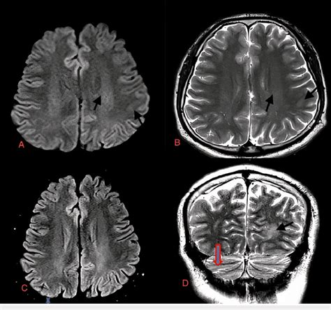 Case 2 Asymmetrical Hyperintensities Are Seen In The Deep And
