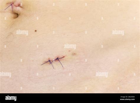Body Scars After Appendicitis Removal Small And Neat Scars After Laparoscopy Surgery Young