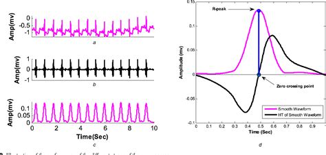 Figure 2 From Automated Qrs Complex Detection Using Mfo Based Dfod
