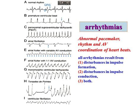 What Is Heart Arrhythmias By Dr Radhika Amulraj Lybrate