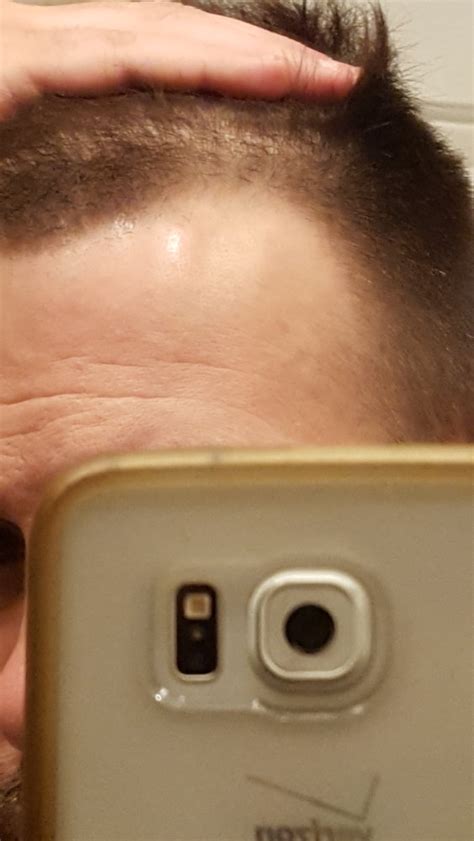 Scalp Threading With Polydioxanone Monofilament Threads A Novel