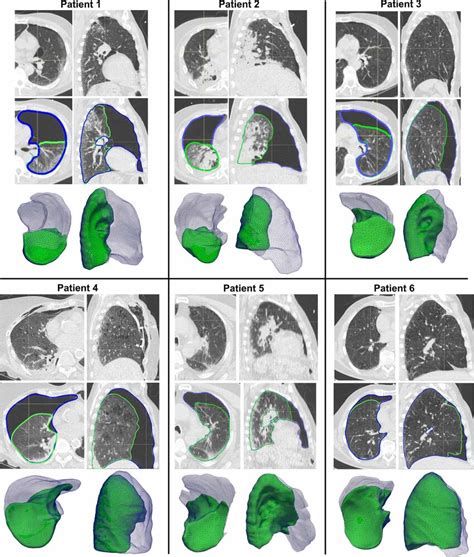Pneumothorax Image Data From The Six Cases Top Row For Each Patient Download Scientific