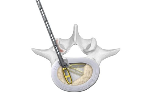 Orbit® Spinal Elements