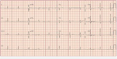 EKG Demonstrating Diffuse T Wave Flattening And T Wave Inversions In V Download Scientific