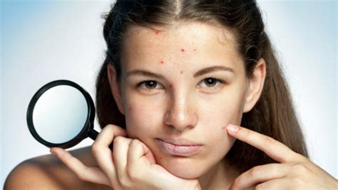 What Are Sex Pimples On The Face Why Do Acne Breakouts Happen