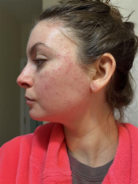 Doxycycline Rebound Rosacea R Rosacea