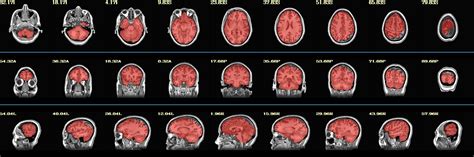severe skull stripping errors post sswarper afni message board afni