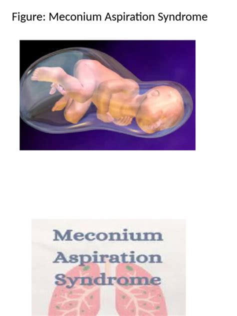 Meconium Aspiration Syndrome Overview Pdf Diseases And Disorders