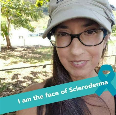 National Scleroderma Foundation You Can Track Clinical Trials For