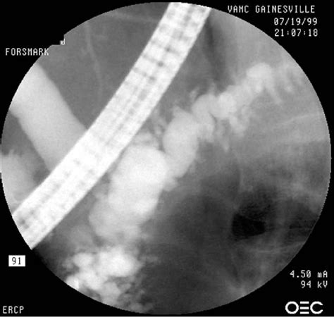 An Endoscopic Retrograde Cholangiopancreatography Ercp Demonstrating Download Scientific