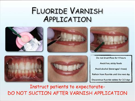 Webinar Using Fluoride Varnish For Improved Patient Outcomes