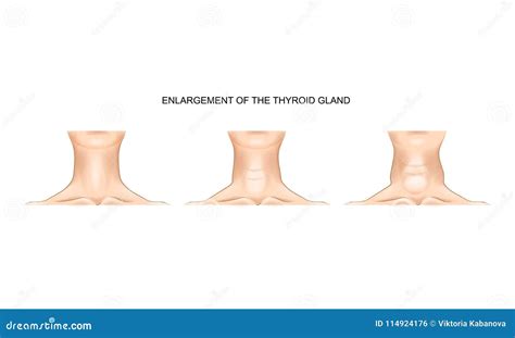Diffuse And Nodular Goiter The Thyroid Gland Is A Sectional View Cartoon Vector Cartoondealer