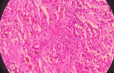 Microscopy Showing Spindle Cells With Moderate Cytoplasm And Elongated