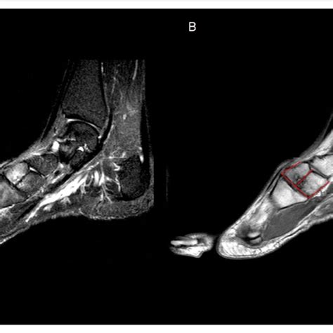 Magnetic Resonance Imaging Showing The Presence Of Bone Marrow Edema Download Scientific